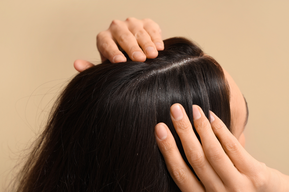Dandruff? Symptoms, Triggers & Treatments – Lust Haircare
